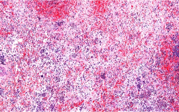 Inrebic獲得FDA批准，成爲近10年來首個獲批的骨髓纖維化藥物 | NAI 500